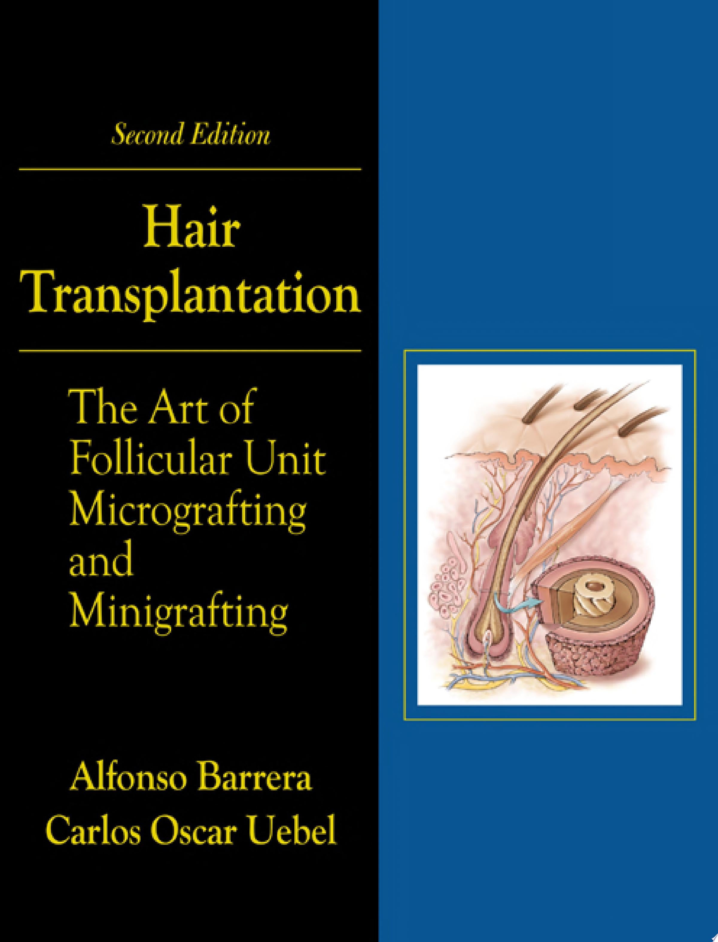Hair Transplantation: The Art of Micrografting and Minigrafting, Secon ...